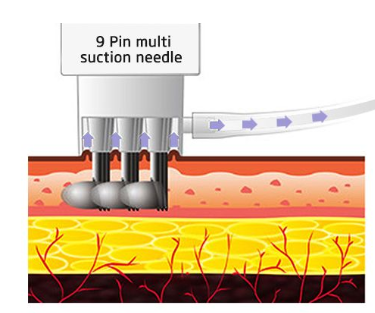 Why Derma Shine Needle injector so popular • Beauty Equipment Factory
